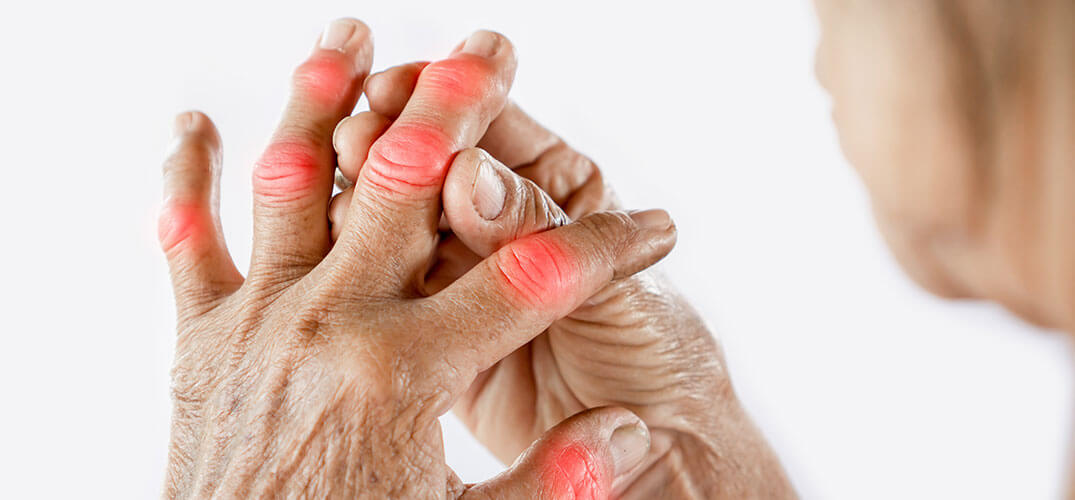 Mucoid Cyst Treatment Perth | Dr Matthew Lawson-Smith